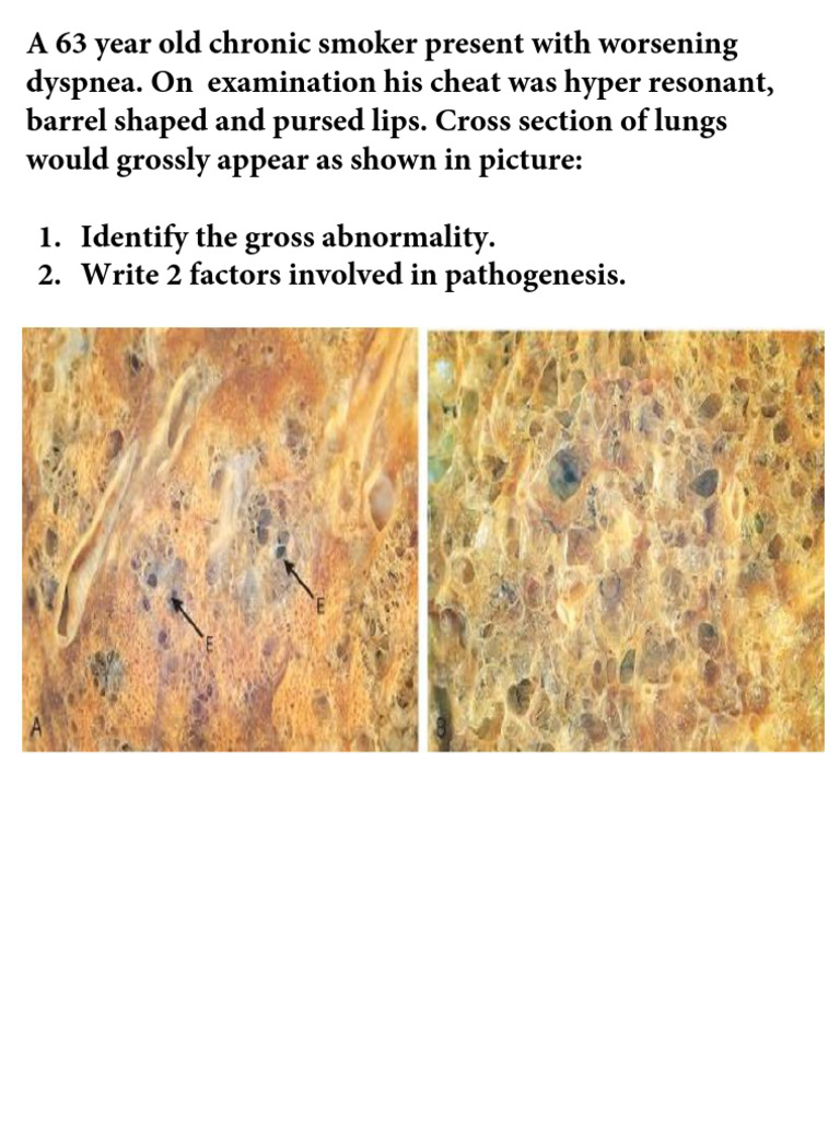 Respiratory 2 OSPE 2020 | PDF