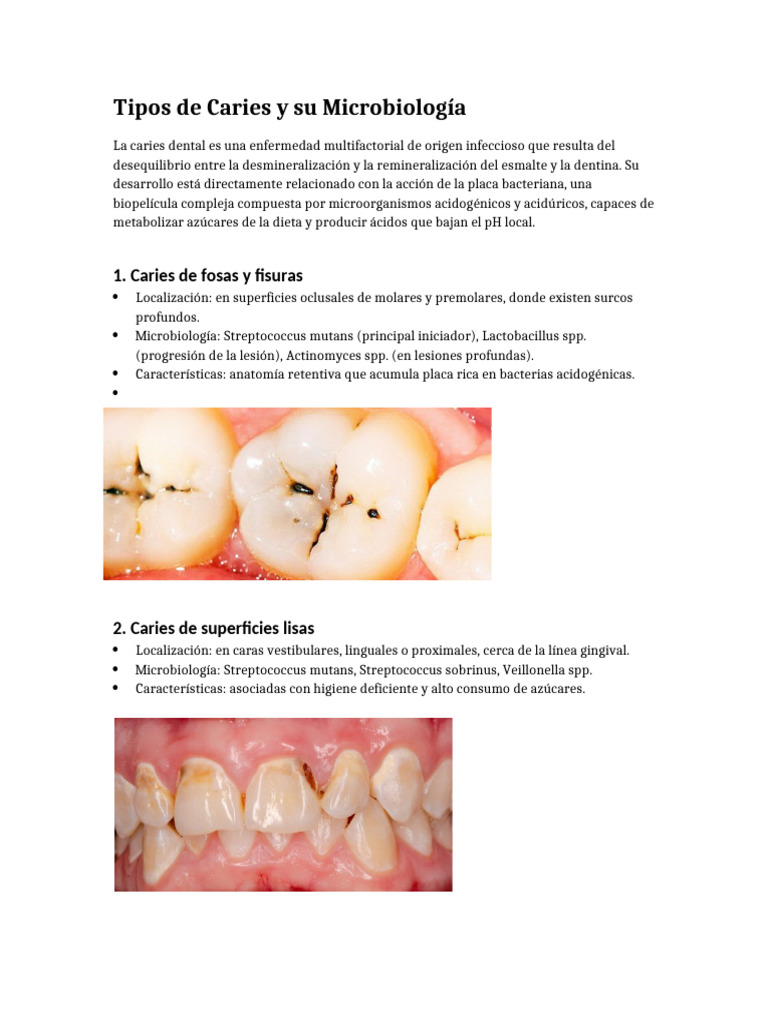 Tipos de Caries y Microbiología Dental | PDF | Especialidades Medicas ...