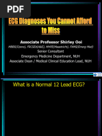 ECG Criteria for STEMI and J-Point | PDF | Electrocardiography ...