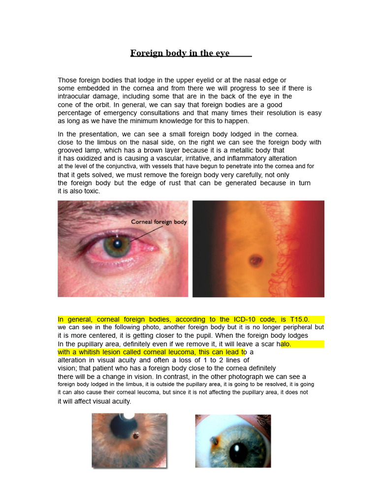 Foreign Body in The Eye | PDF | Cornea | Human Eye