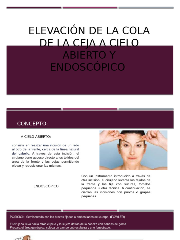 Elevación de Cola de Ceja: Técnica Quirúrgica | PDF | Cirugía | Cirujano