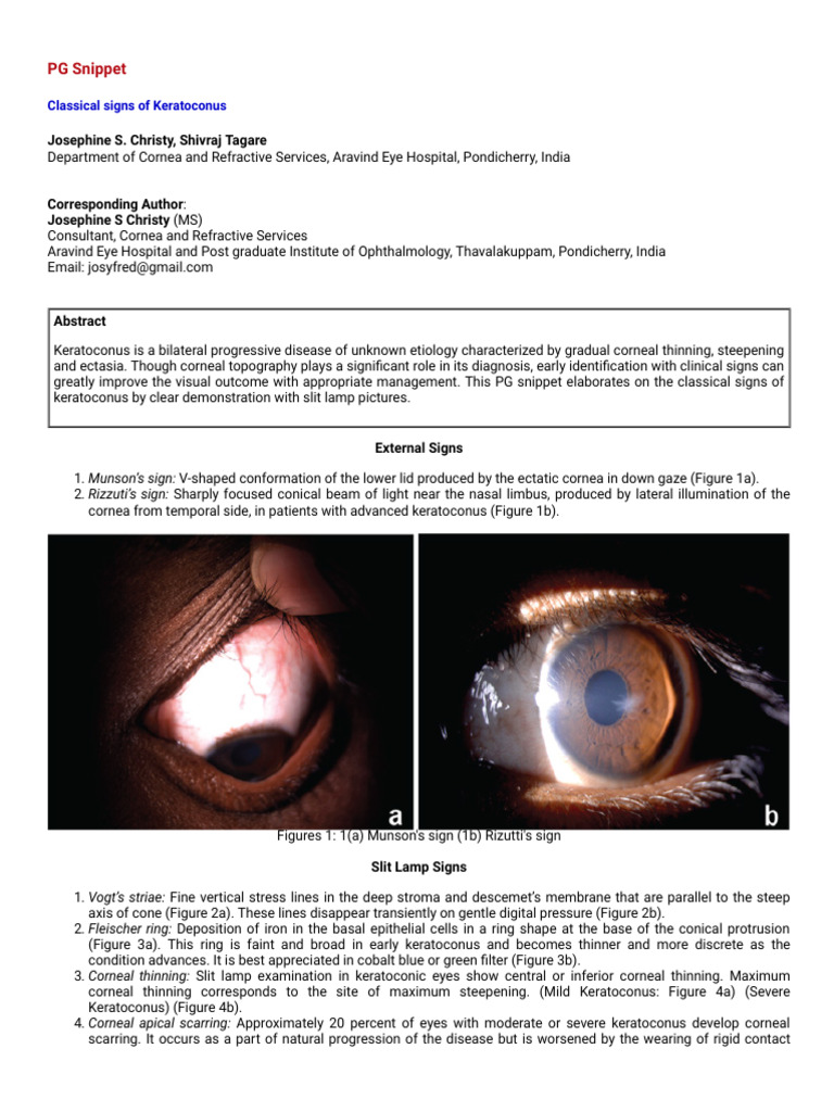 Classical Signs of Keratoconus | PDF | Cornea | Light
