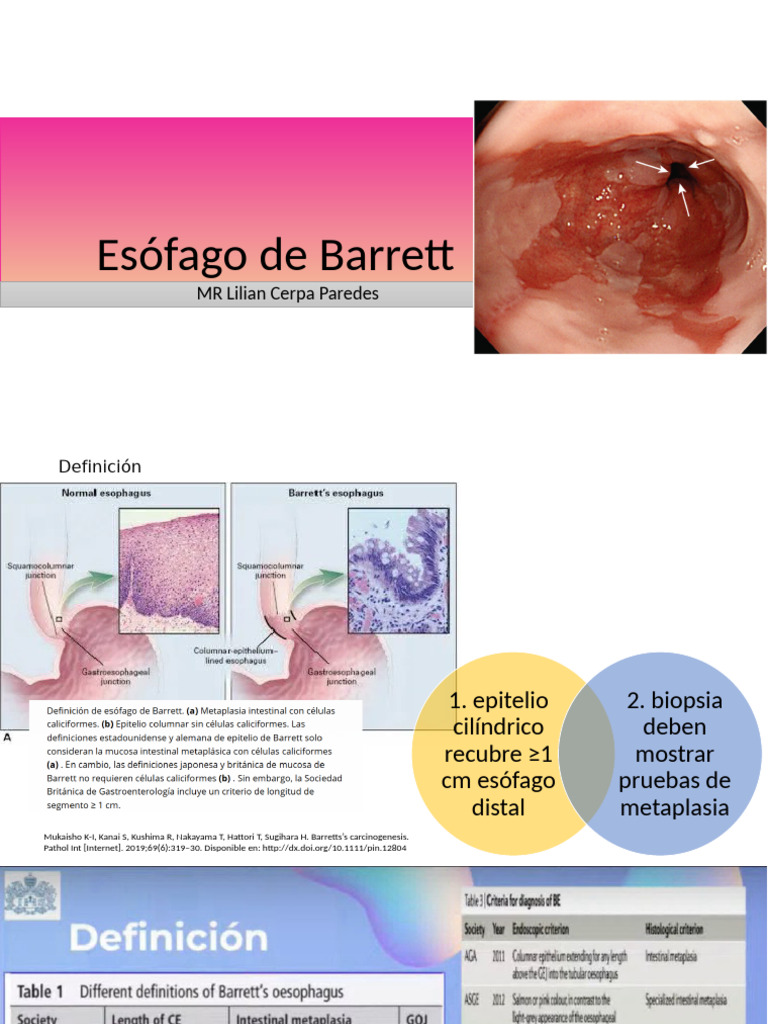 Esófago de Barrett | PDF | La enfermedad por reflujo gastroesofágico ...