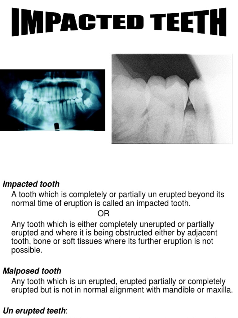 Impacted Teeth Part A | PDF | Tooth | Medicine