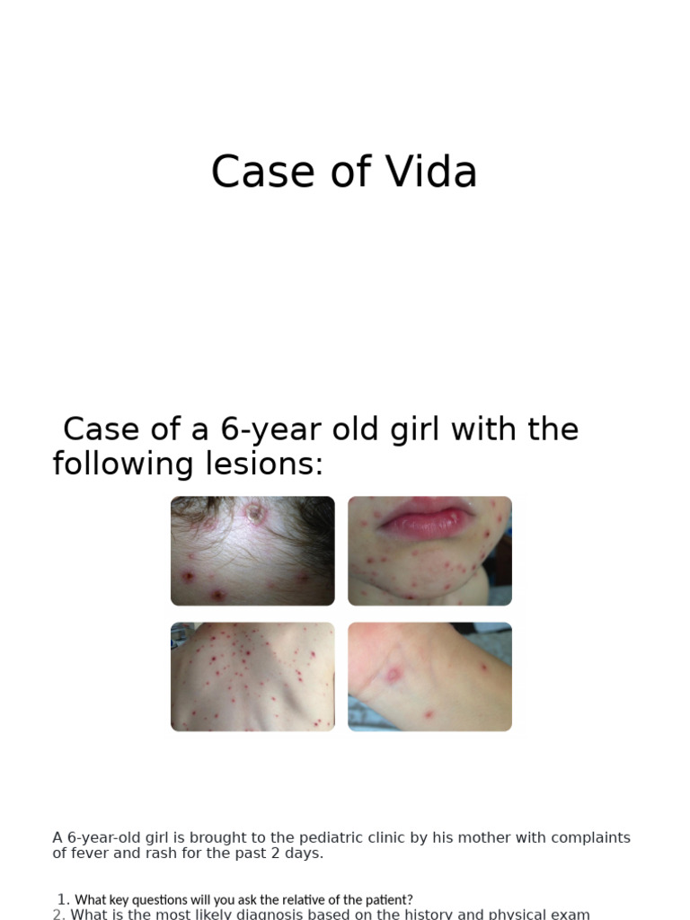 Case of Vida Varicella 17fc8cb8 b5ff 4eae 80d8 A6c45f7c83fa | PDF