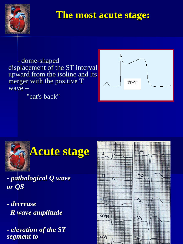 ECG Signs of Acute Myocardial Infarction | PDF