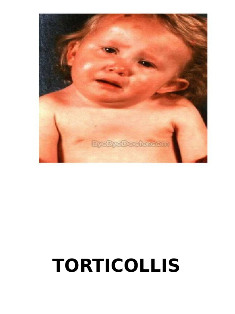 TORTICOLis Disease | PDF