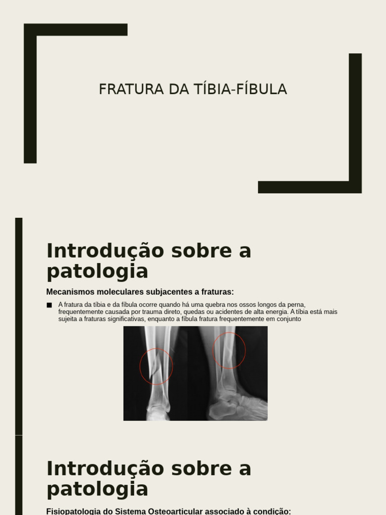 Fratura de Tíbia e Fíbula: Diagnóstico e Tratamento | PDF | Dor | Joelho