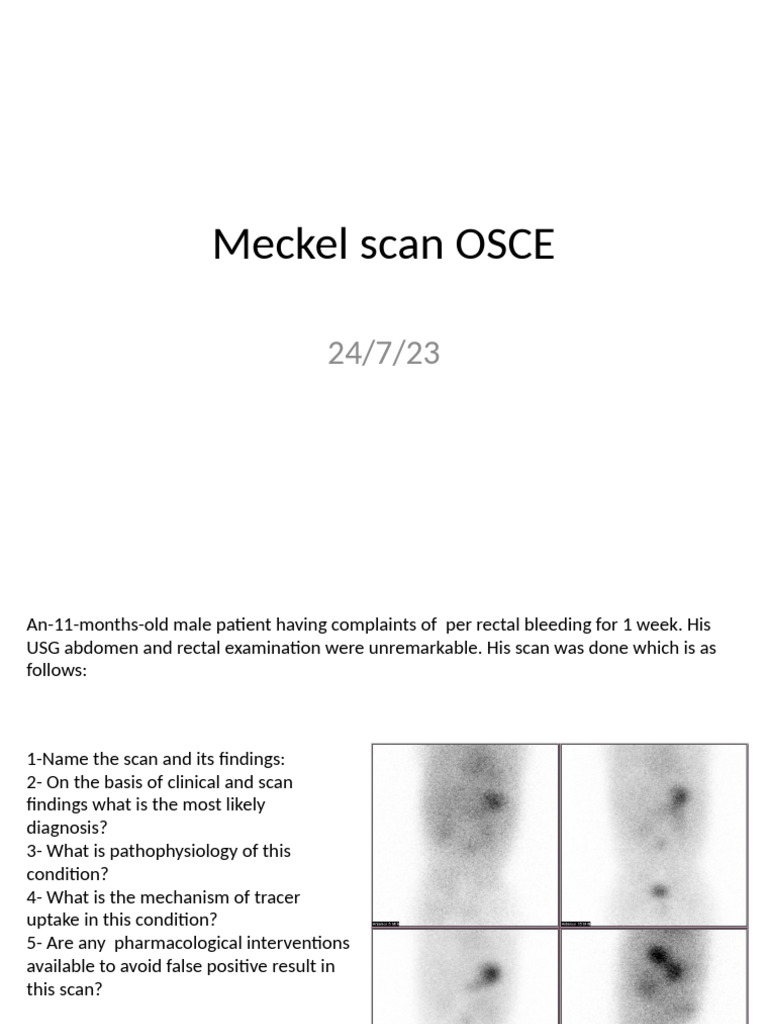 Meckel Scan OSCE | PDF