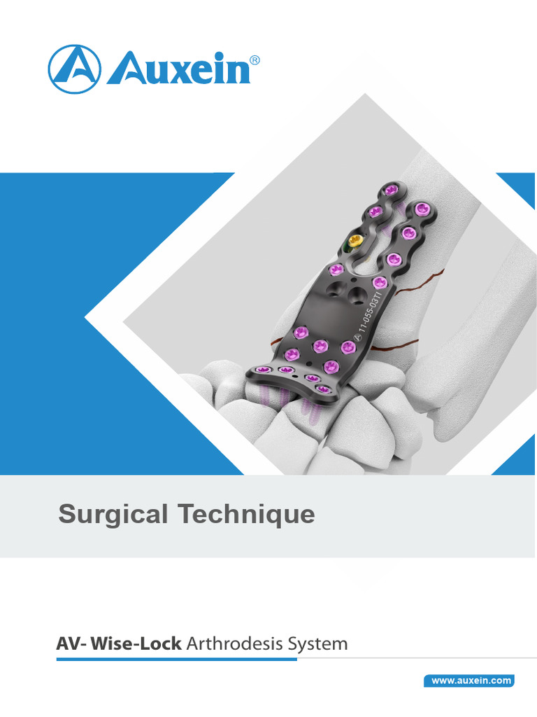 AV-Wise Lock Arthrodesis System Guide | PDF | Hand | Screw
