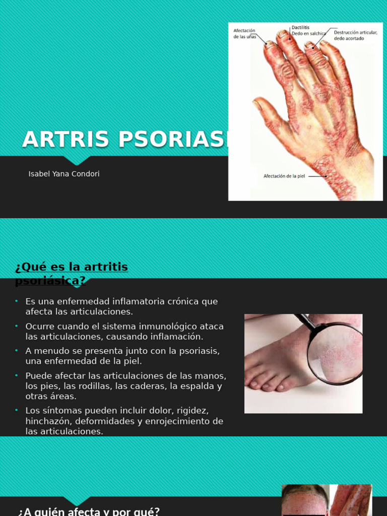 Artris Psoriasica | PDF | Artritis | Psoriasis