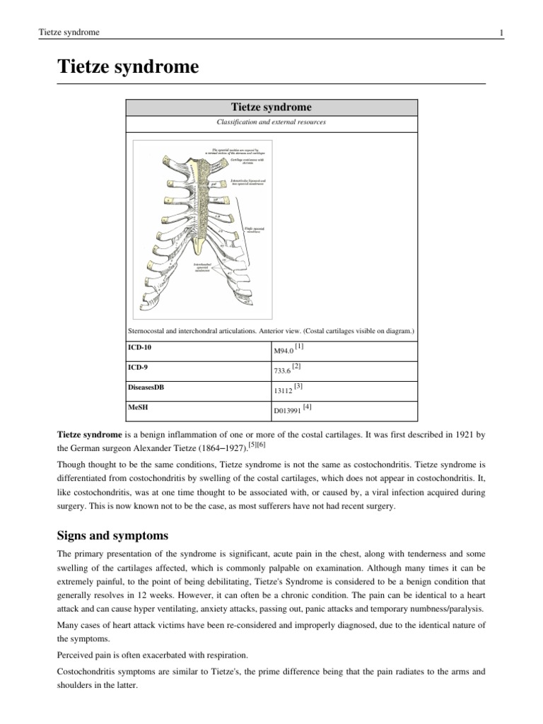 Tietze Syndrome | PDF | Diseases And Disorders | Clinical Medicine