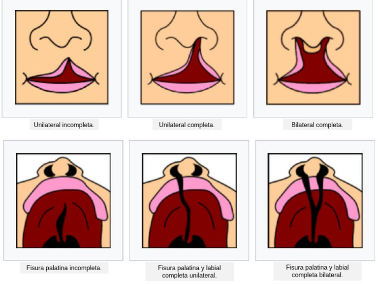 Clasificacion Labio y Paladar Hendido, Medicina | PDF