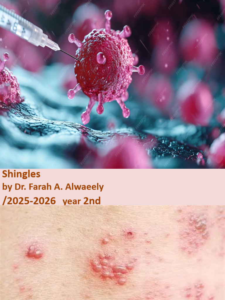 Understanding Shingles: Causes and Treatment | PDF | Virus | Medicine