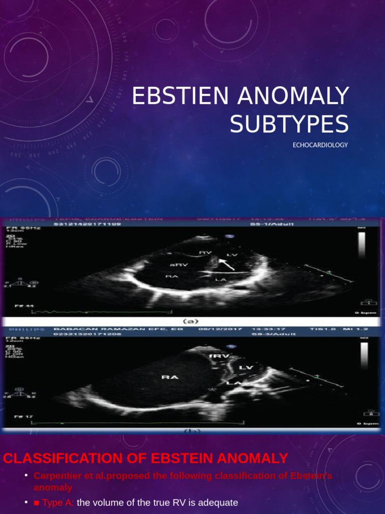 Ebstein Anomaly: Classification and Case Study | PDF | Ventricle (Heart ...