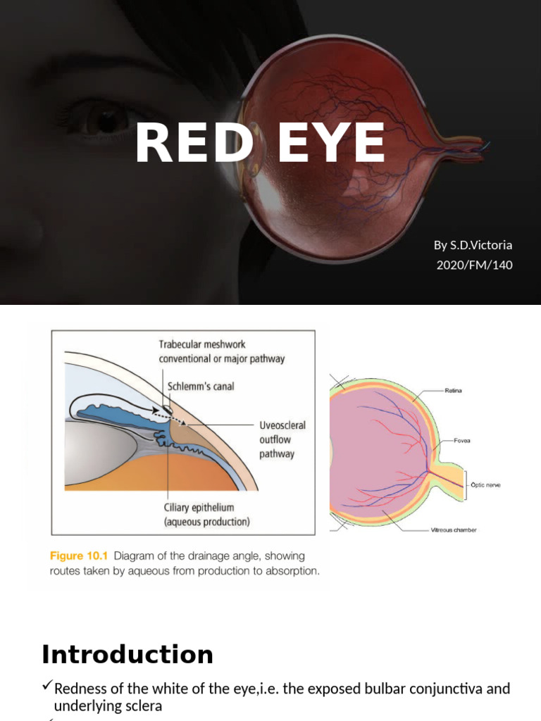 Understanding Red Eye Causes and Management | PDF | Human Diseases And ...