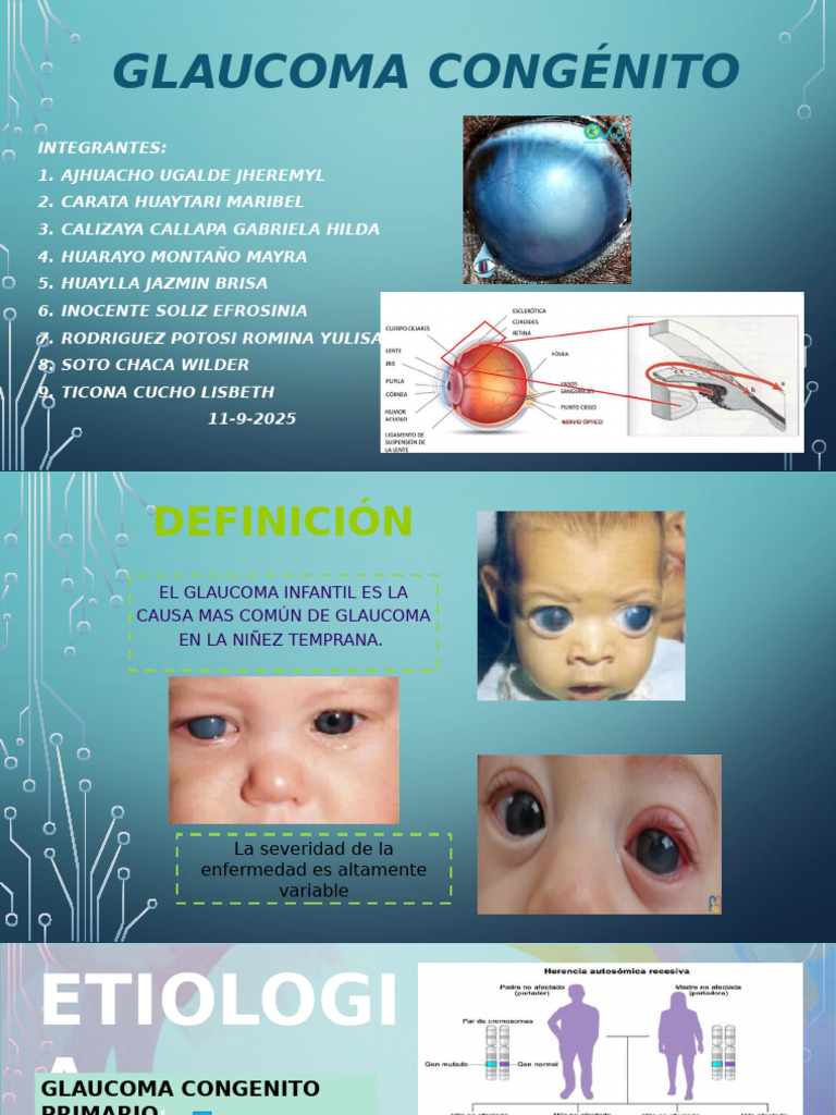 Glaucoma Congénito: Diagnóstico y Tratamiento | PDF | Glaucoma ...
