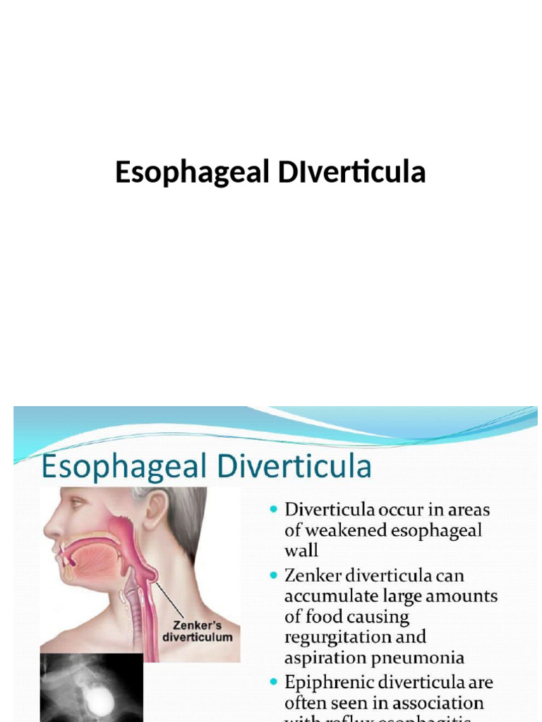 Esophageal Diverticula | PDF | Esophagus | Medical Specialties
