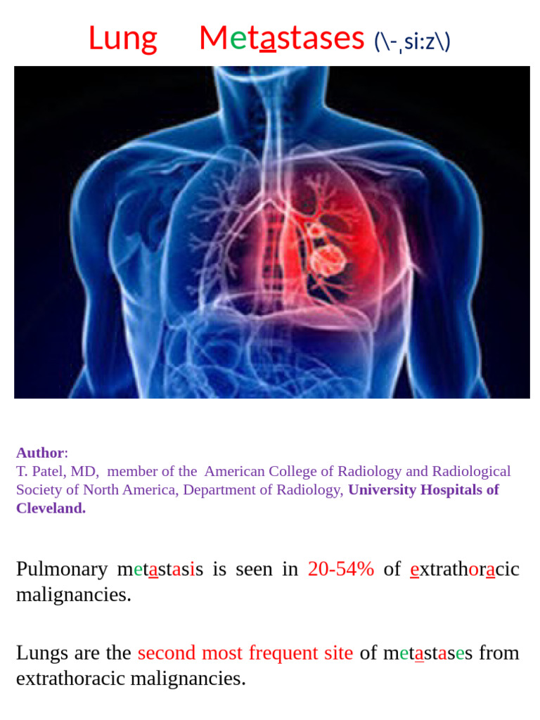 Lung Metastases 44627b4d C6a6 4fb3 84a1 Becdae62dca8 | PDF | Metastasis ...