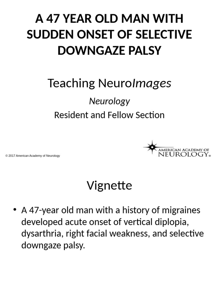 Selective Downgaze Palsy Case Study | PDF