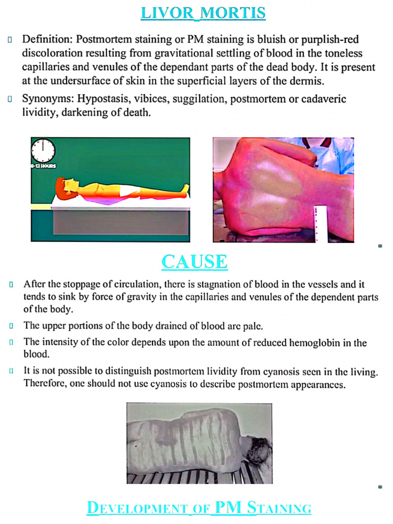Livor Mortis (PM Lividity) AHM | PDF