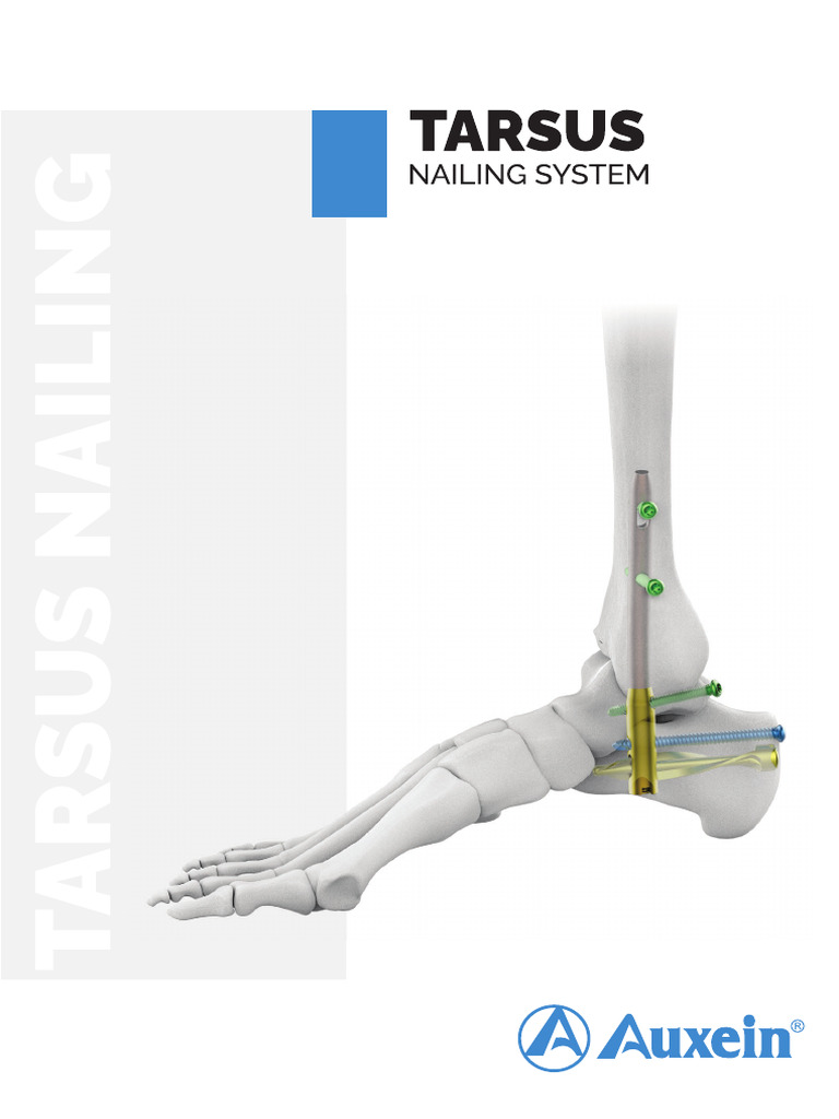 Tarsus Nailing System | PDF
