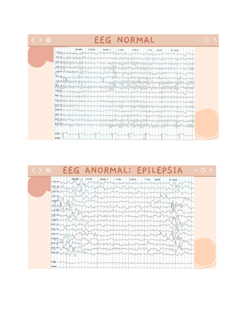 Eeg | PDF
