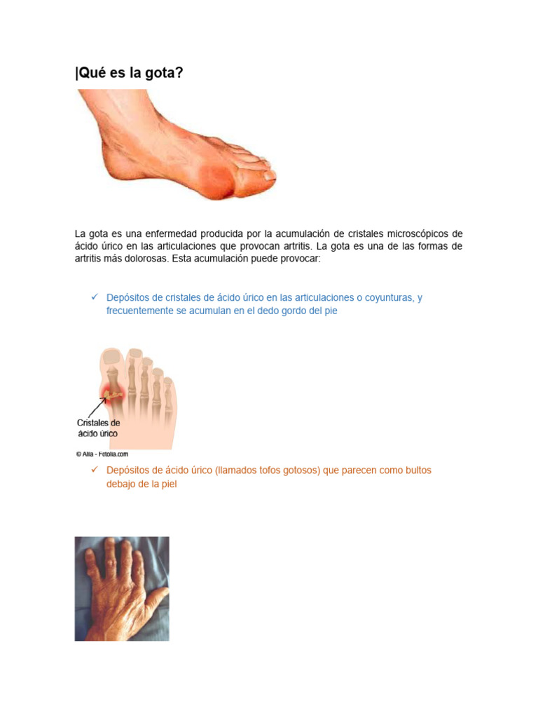Gota: Causas y Tratamientos | PDF | Gota | Especialidades Medicas