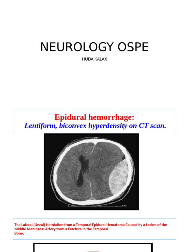 Neurology OSPE: Hemorrhage Types & Signs | PDF