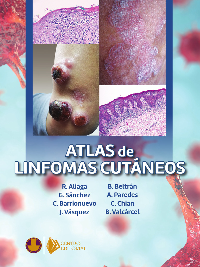 Atlas de Linfomas Cutáneos 2025 | PDF | Linfoma | Piel