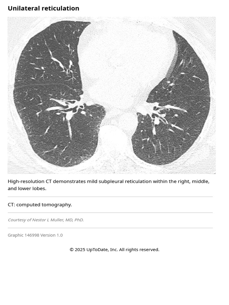 Unilateral Reticulation in CT Imaging | PDF