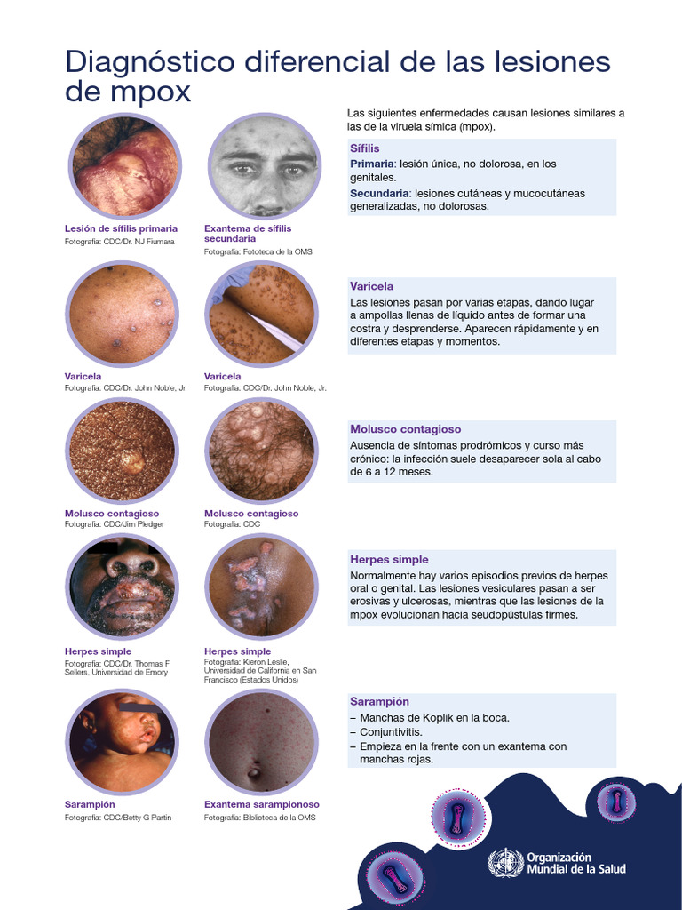 Mpox Lesions Differential Diagnosis Spa | PDF | Sarampión | Salud pública
