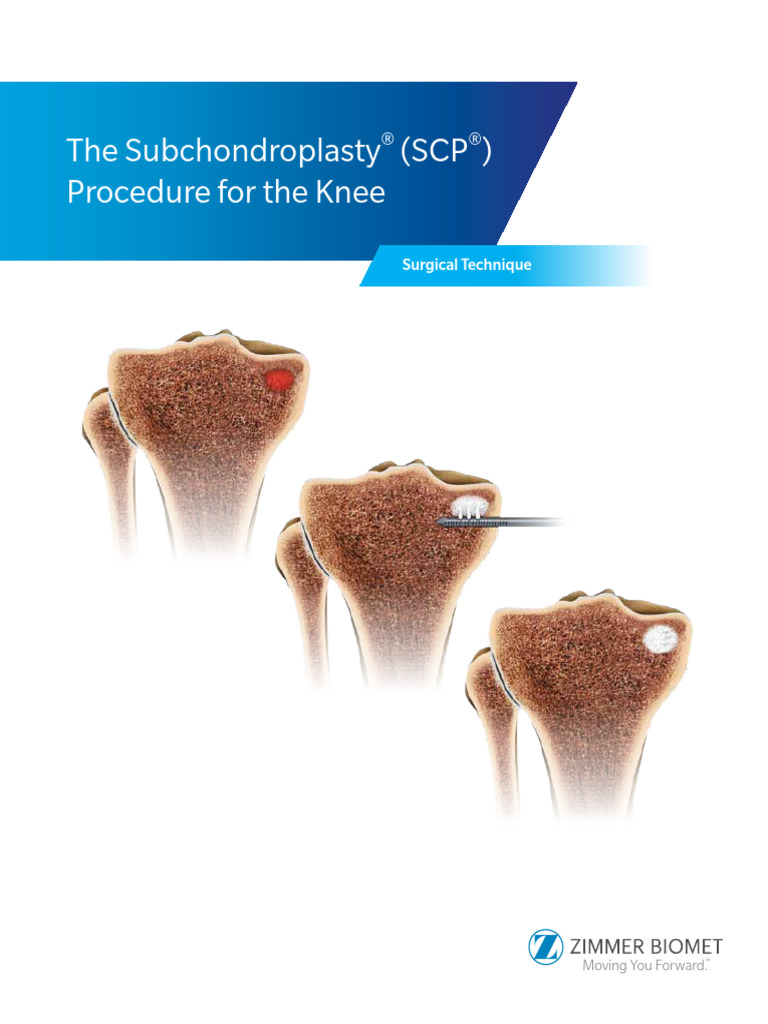 Subchondroplasty SCP Procedure Overview | PDF | Knee | Syringe