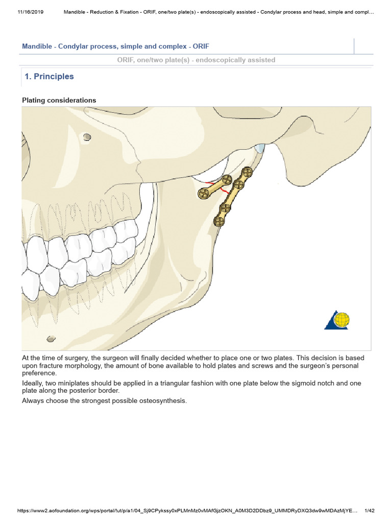 Principles: ORIF, One/two Plate(s) - Endoscopically Assisted | PDF ...