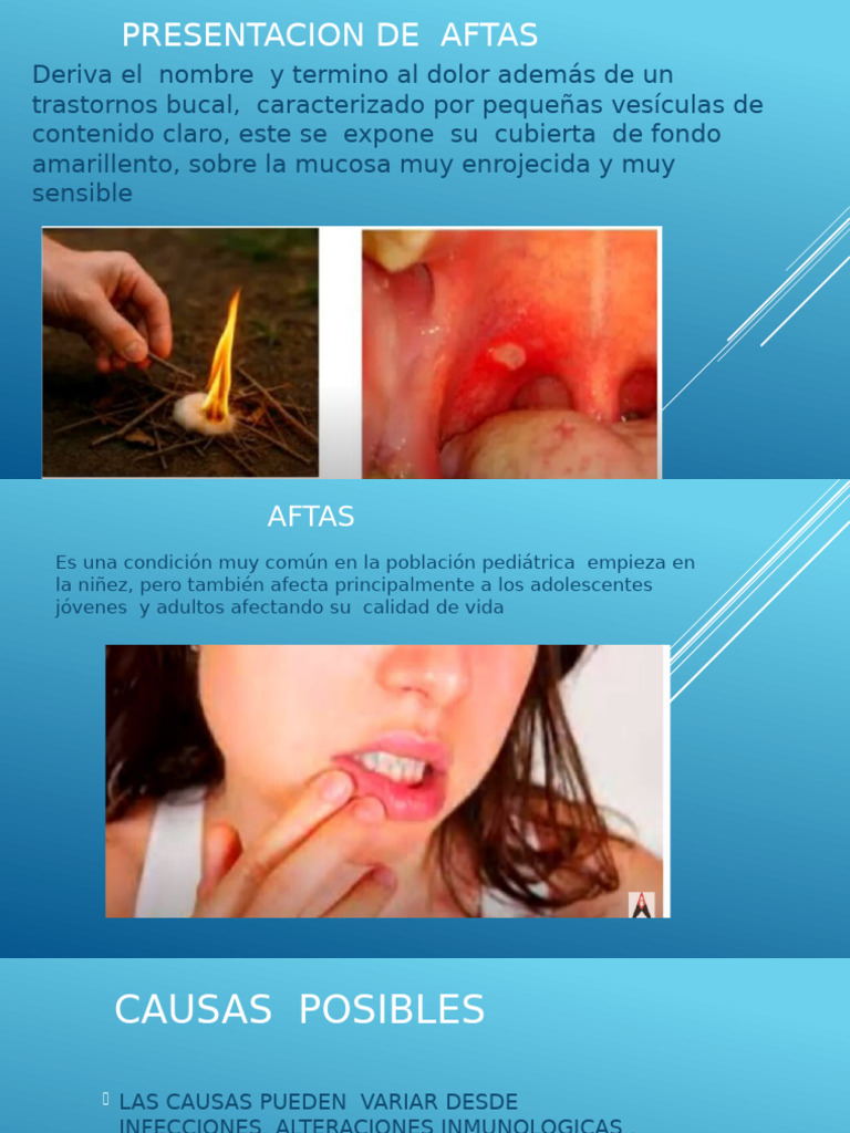 Causas y tipos de aftas bucales | PDF | Medicina | Inmunología
