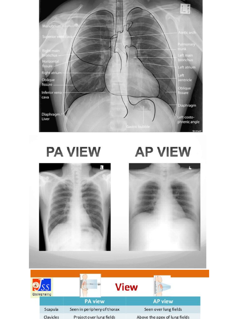 Normal Chest X-Ray | PDF