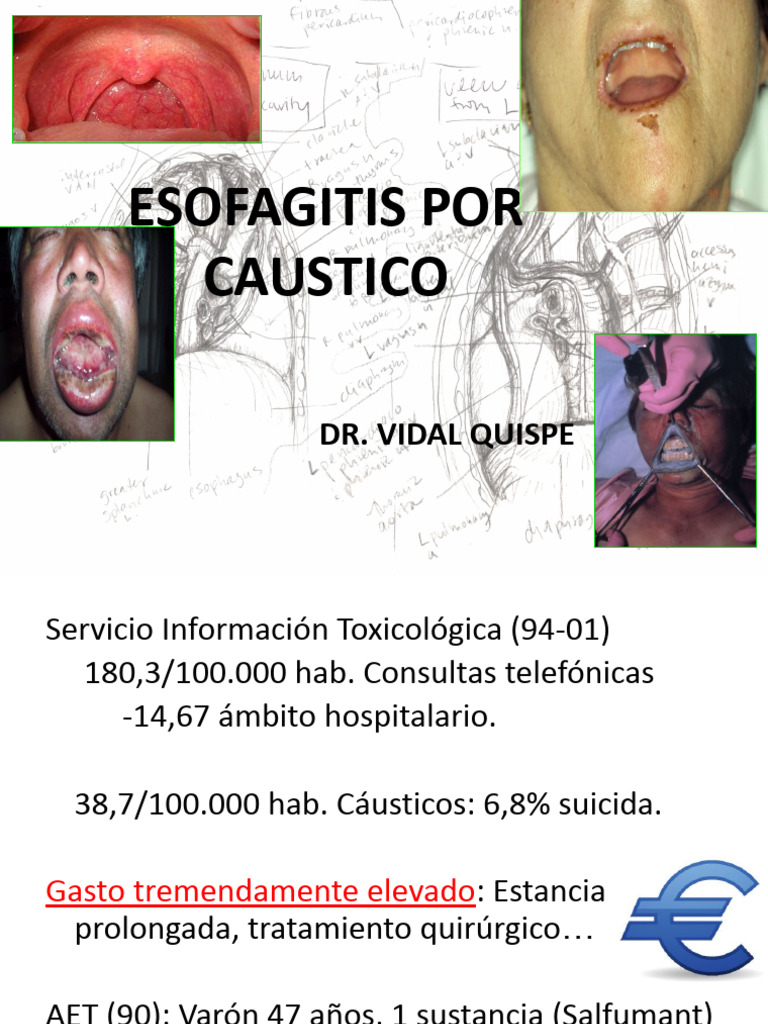 Esofagitis por Cáusticos: Diagnóstico y Tratamiento | PDF | Estómago ...