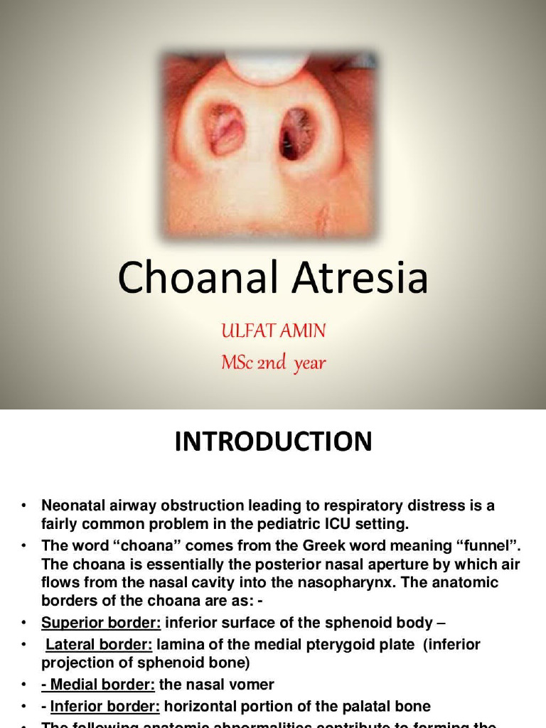 Choanal Atresia 129354064 | PDF