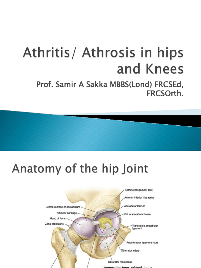 Arthritis in Hips | PDF