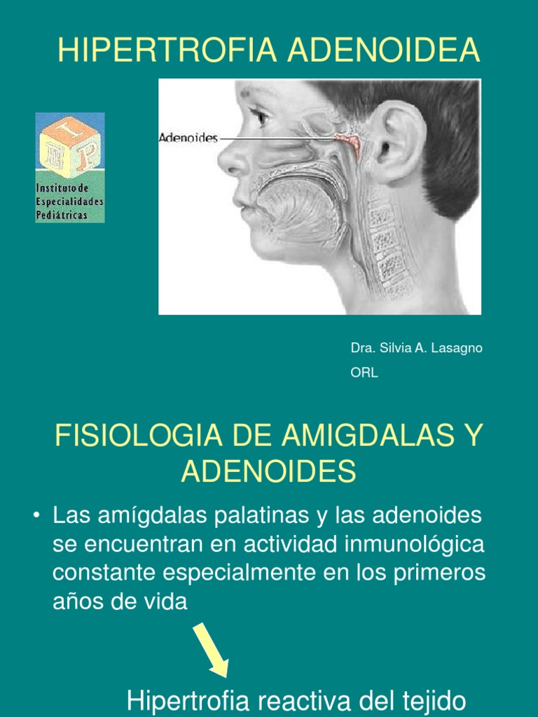 Hipertrofia adenoidea: causas, síntomas y tratamiento | PDF