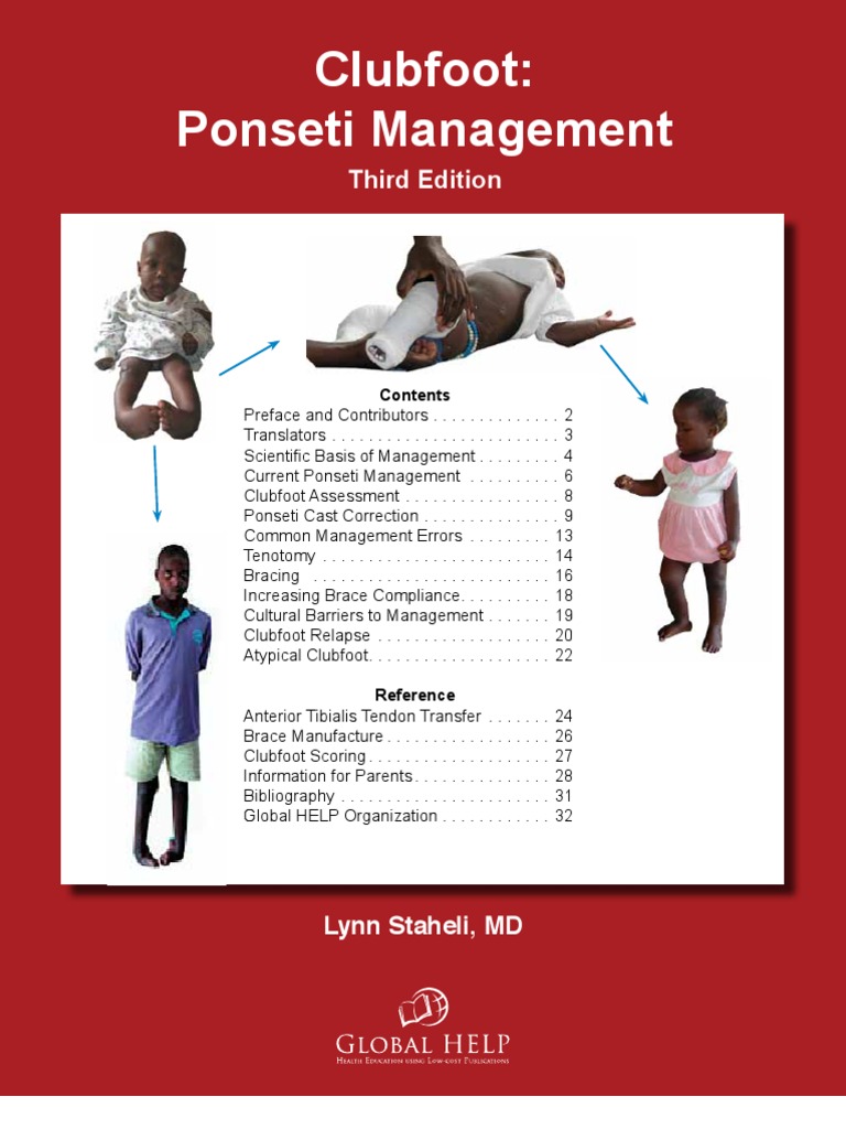 Clubfoot Ponseti Management, 3rd Edition-1601890028 | PDF | Foot ...