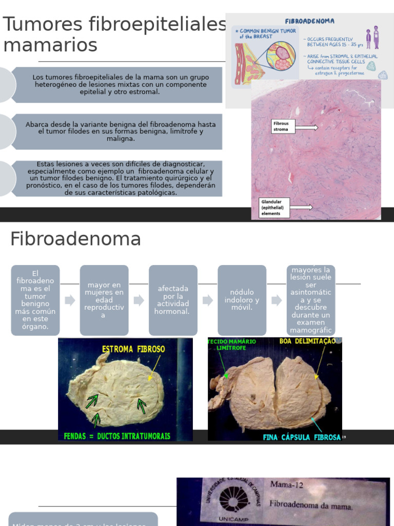 Fi Broaden Om As | PDF | Neoplasias | Tumor benigno