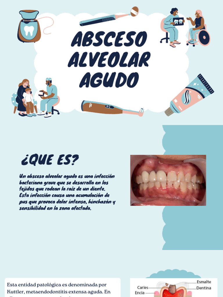 Absceso Alveolar Agudo | PDF