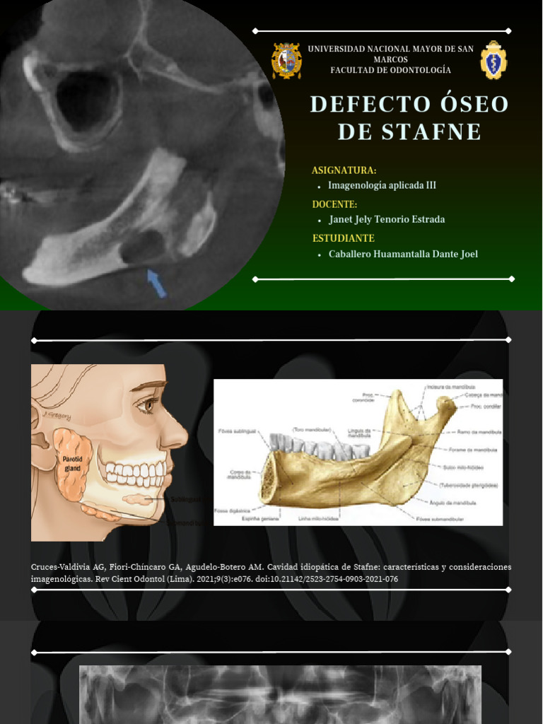 Defecto Oseo de S. | PDF