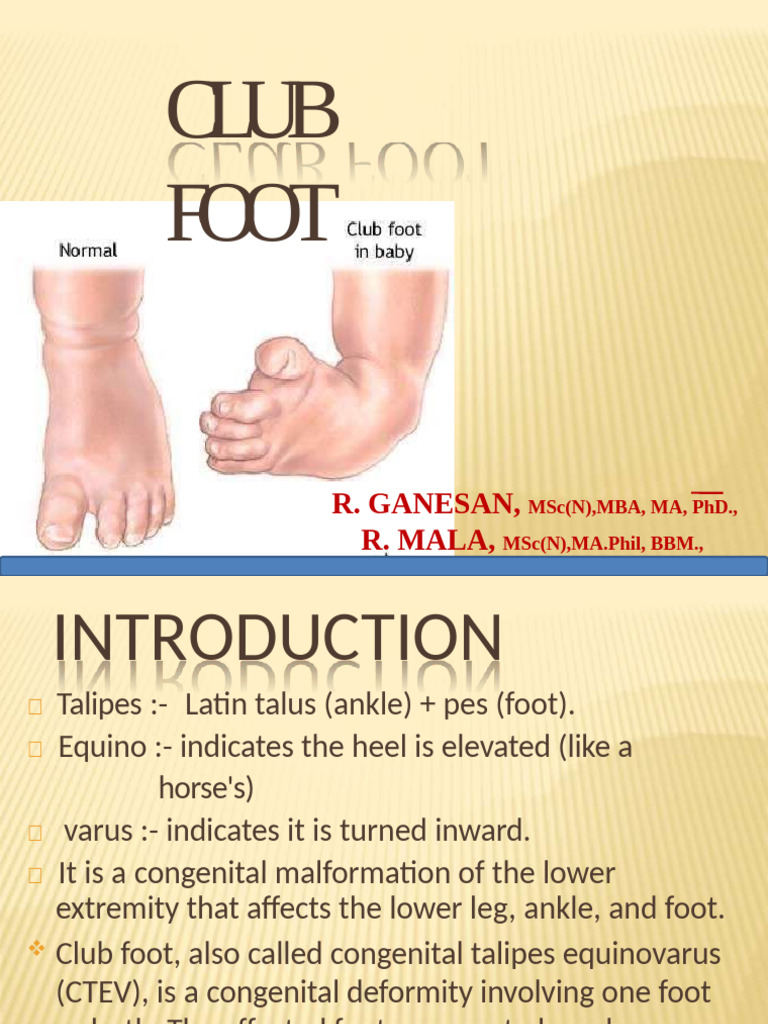 Understanding Clubfoot: Causes, Treatment, and Impact | PDF | Foot | Ankle