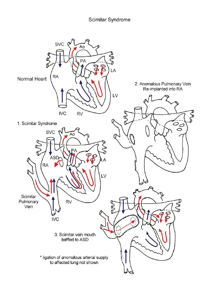 Scimitar Syndrome | PDF
