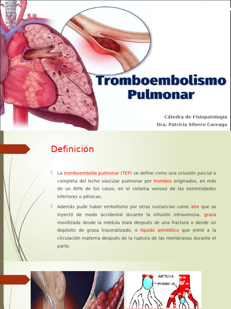 Tromboembolismo Pulmonar 2 | PDF | Trombo | Infarto de miocardio