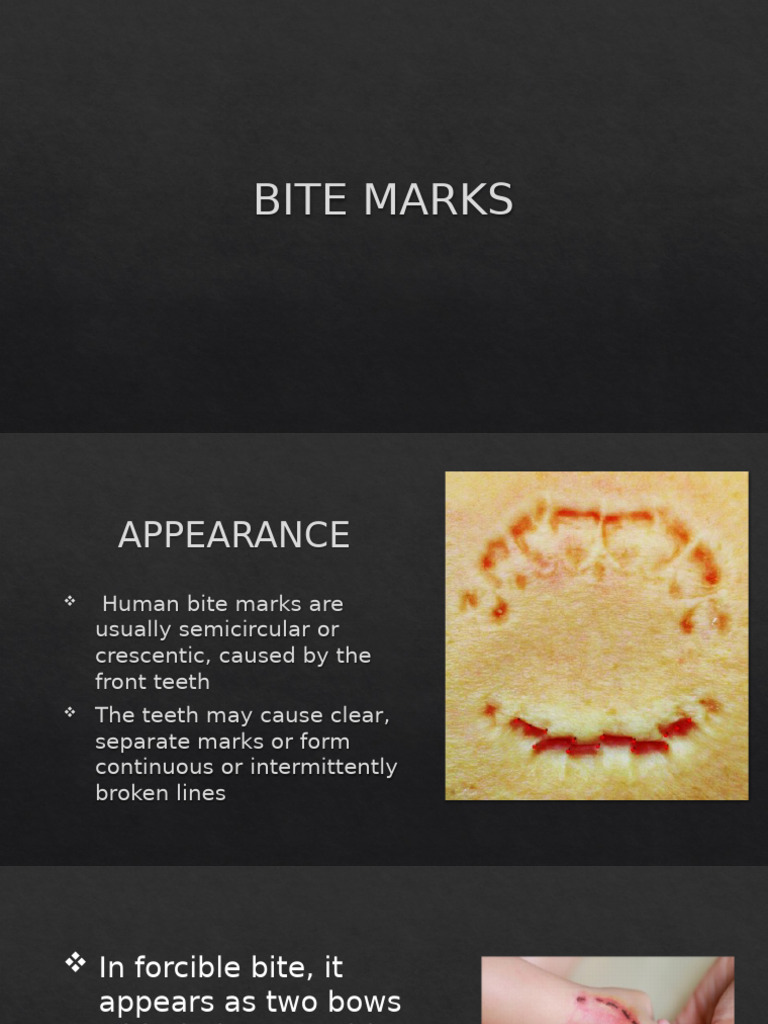 Understanding Human and Animal Bite Marks | PDF | Tooth | Dental Anatomy