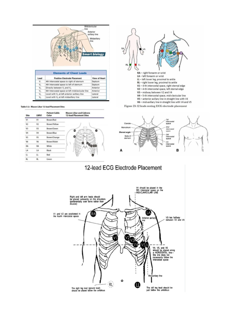 ECG Picture | PDF