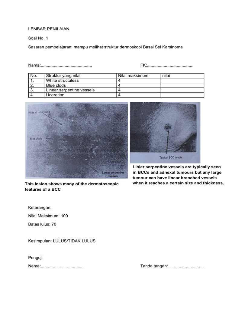 Struktur Dermoskopi Basal Sel Karsinoma | PDF